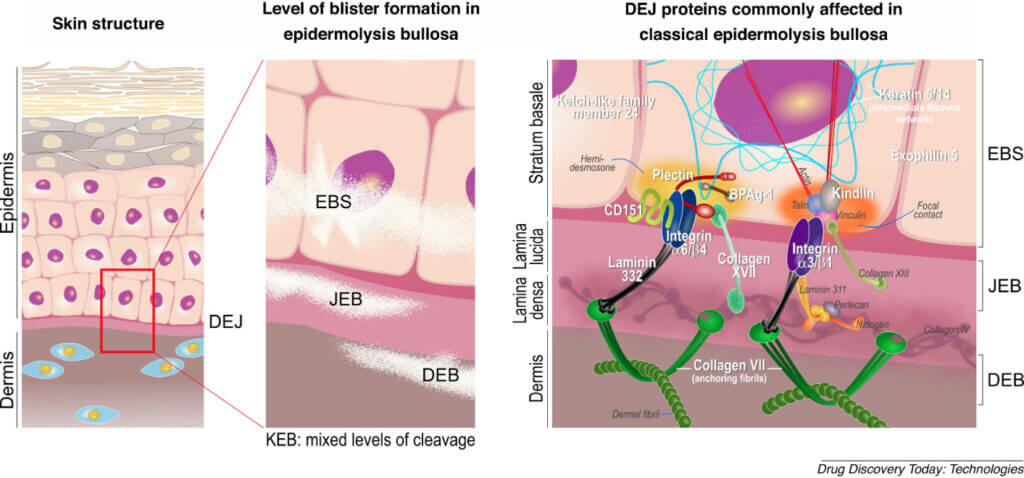 What is Epidermolysis Bullosa (EB)? - Paradigm Therapeutics