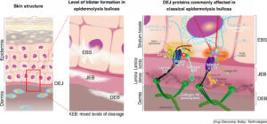 What is Epidermolysis Bullosa (EB)? - Paradigm Therapeutics